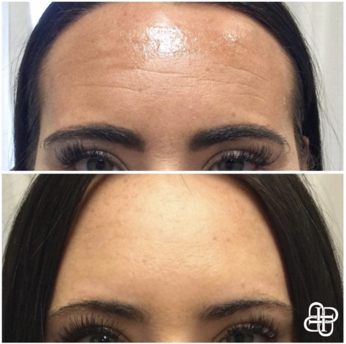 Privé Med Spa Lexington KY, Before & After of Botox for Forehead ...