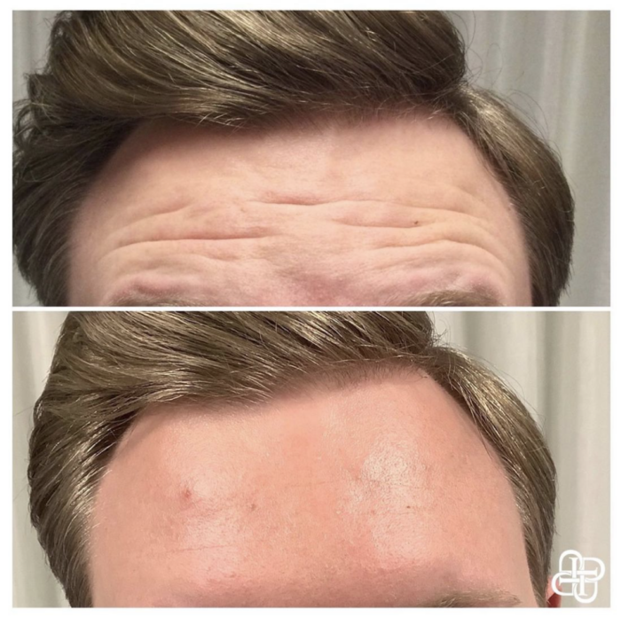 Privé Med Spa Lexington KY, Before & After of Botox for Forehead for ...
